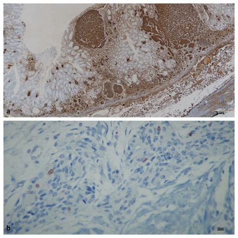 A Chromogranin Expression In Tumor Cells ×20 B Ki 67 Expression In