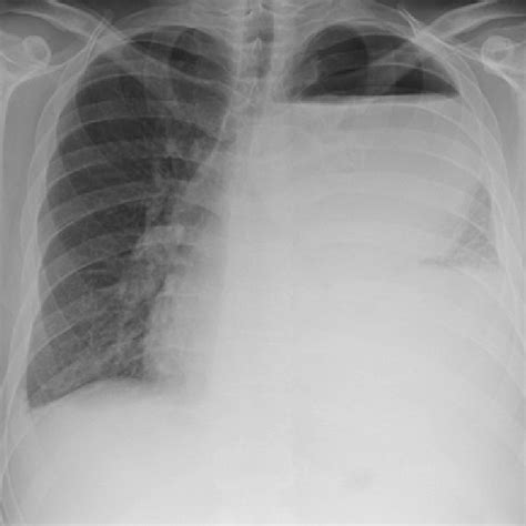 Chest X Ray One Week Prior To Admission Left Lower Lobe Infiltrate And