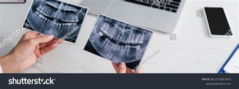 93 Thousand Bitewing Tabs Dental X Ray Royalty Free Images Stock