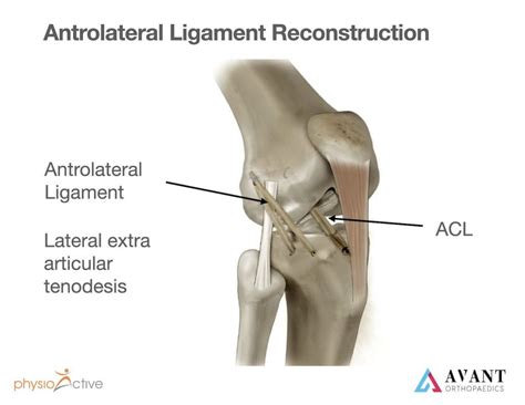ACL Repair Reconstruction With Dr Ramesh Subramaniam PhysioActive
