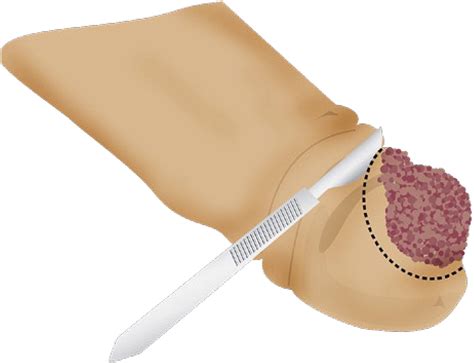 Surgical Management Of Carcinoma Of The Penis Urologic Clinics