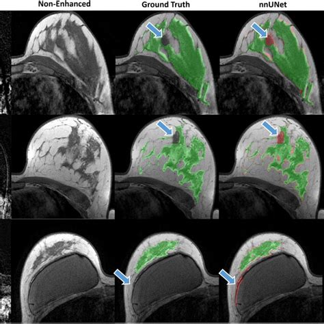 Sample MRI Examinations Of The External DUKE Dataset The Two Leftmost