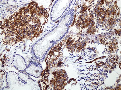 Pathology Outlines Gastrointestinal Stromal Tumor GIST