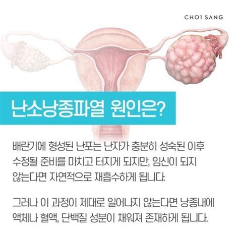 자궁난소파열이 아니라 난소낭종파열 Mlbpark