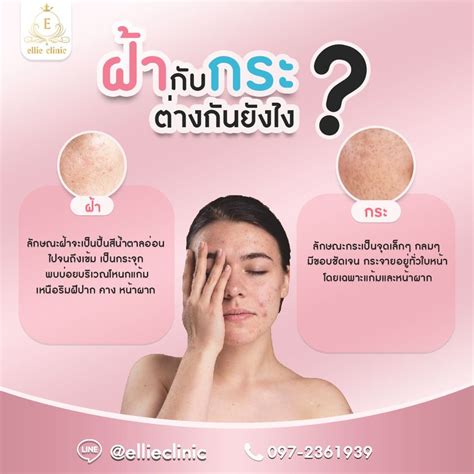 “ฝ้า”กับ”กระ”แตกต่างกันอย่างไร Ellie Clinic