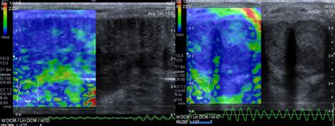 Evidence Of Large Anelastic Area In Correspondence Of The Solid Lesion Download Scientific