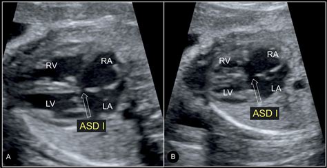Atrial Septal Defect Ultrasound