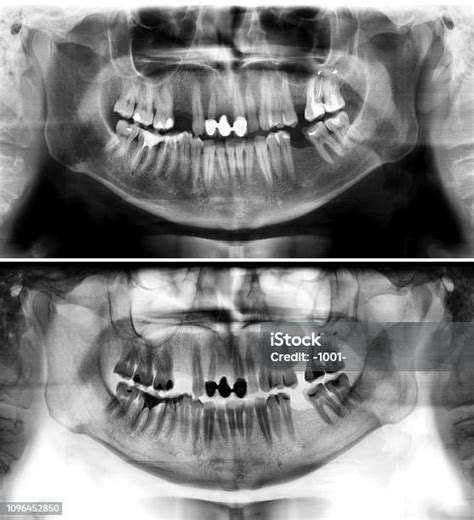 파노라마 방사선 사진 위 턱과 아래 턱의 파노라마 스캔 치과 엑스레이 이다 이것은 한 초점 비행기 단층 보여준다는 Maxilla 30 7 세 남자의 Cat 스캔에 대한 스톡