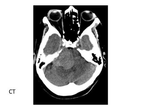 Diagnostic Imaging Of Cerebellopontine Angle Masses