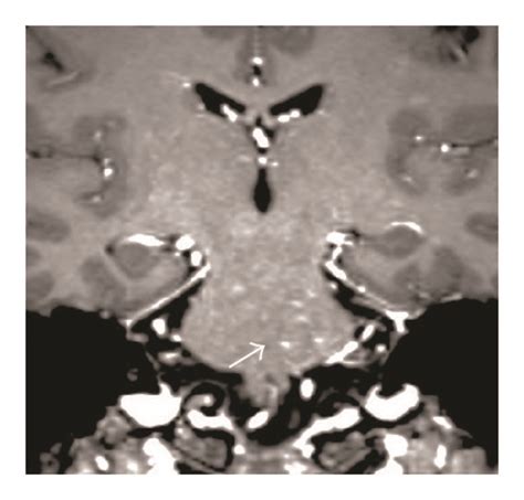 A Axial T2flair And B Axial And Sagittal C T1 Weighted Mri After