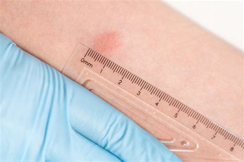 Ppd Test Solutions Mobile Health Professional Nashville