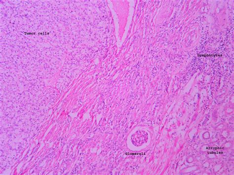 Renal Cell Carcinoma Ug Slide Histopathologyguru