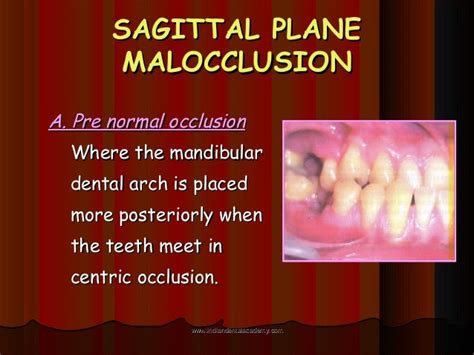 Malocclusion Certified Fixed Orthodontic Courses By Indian Dental