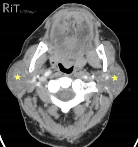 Rit Radiology Lymphoepithelial Cysts In Hiv