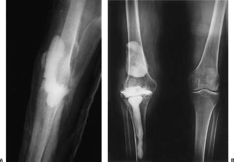 Infected Total Knee Replacement Cement Spacer Musculoskeletal Key