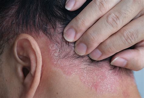 Psoriasis Kulit Kepala Gejala Penyebab Dan Penanganan Rs Pondok Indah