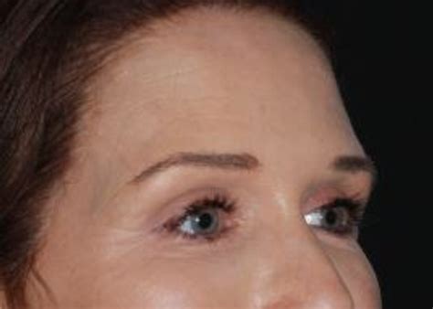Brow Lift Atlanta Ga Brow Lift Surgery Atlanta