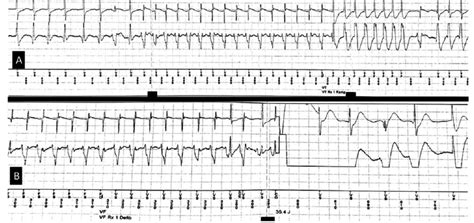 A The Intracardiac Electrogram Shows An Episode Of Ventricular