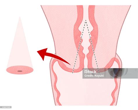 Blank Cervical Conization Unlabeled Diagram Stock Illustration