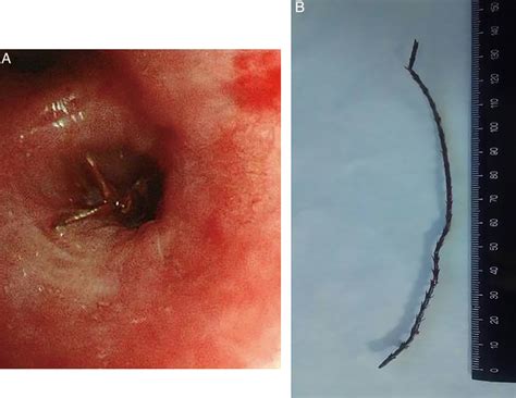 A Bronchoscopic Finding Shows A Dark Brown Rigid Foreign Body In The