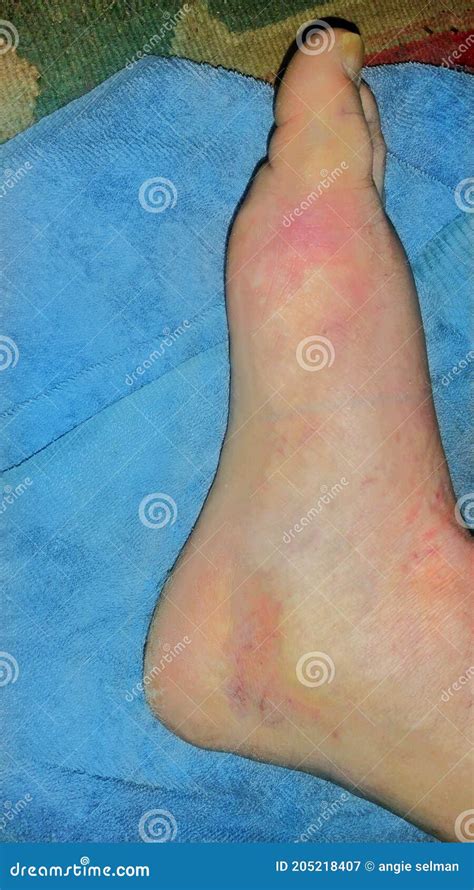 Rood En Gezwollen Voet Gekneusd Stock Afbeelding Image Of Been