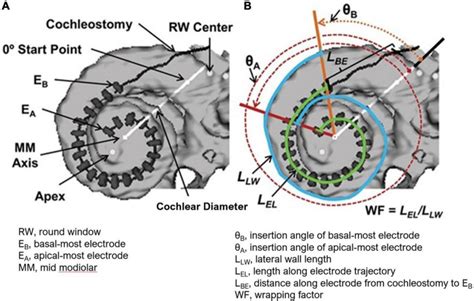 Is Characteristic Frequency Limiting Real Time Electrocochleography
