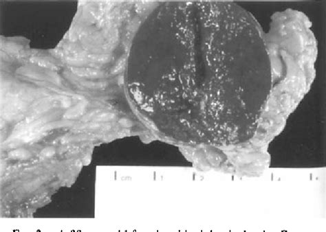 Splenic Capsule Structure Semantic Scholar