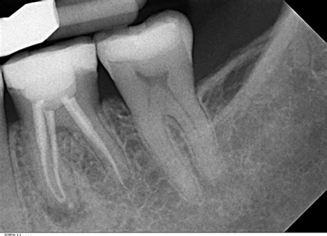 Apicoectomy Mississauga On