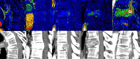Association Of Ct Dsa Vascular Assessment And Perioperative Outcomes In