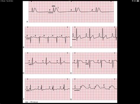 CVT Chapter Flashcards Quizlet
