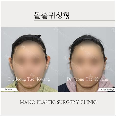 마노성형외과 귀성형 알아둘 점과 돌출귀성형 전후 사례 자세히 알아보기
