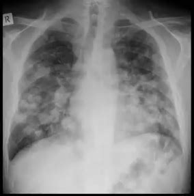 Pulmonary Emergencies Flashcards Quizlet