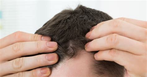 DHT Benefits Blockers How To Increase Decrease Levels Treatment