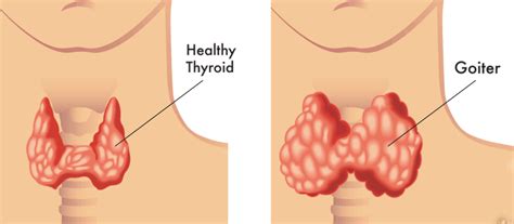 10 Signs You Have A Thyroid Problem And How To Deal With It Women