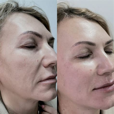 Unlock Skins Regeneration Power With Jalupro Skinviva Clinic