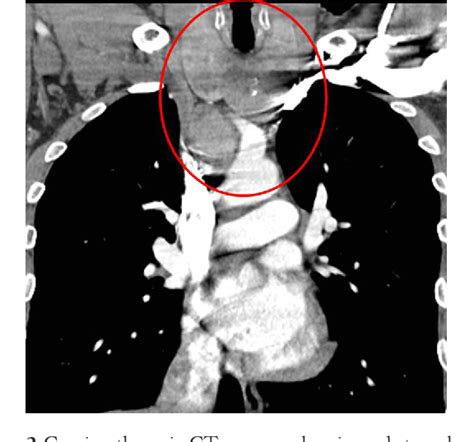 Structure Of Thyrocervical Trunk Semantic Scholar