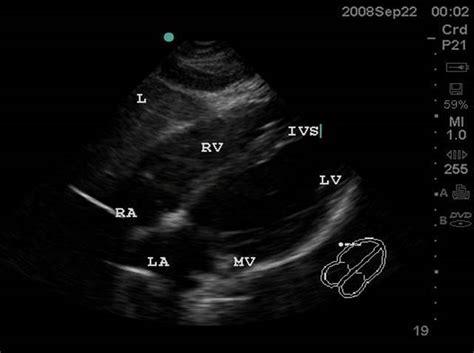 Sonoguide Echocardiography For Emergency Physicians