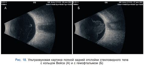Рис 18 Ультразвуковая картина полной задней отслойки стекловидного т…