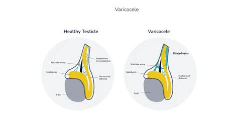 Varicocele Infertility Causes Symptoms Treatment And Surgery
