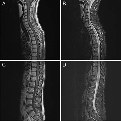 A 42 Year Old Right Handed Man With Metastatic Melanoma Developed