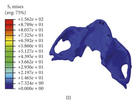 Stress Distribution And Intensity Heat Map Of The Maxilla In The Nine