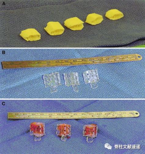 News Open Door Posterior Cervical Laminoplasty Procedure