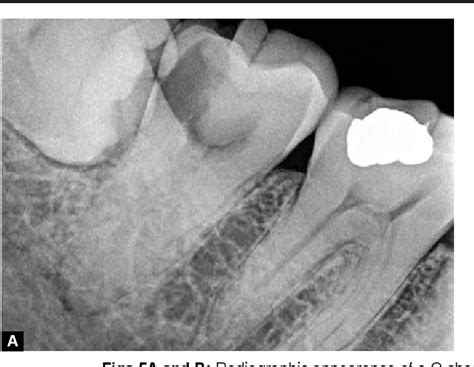 Figure 5 From Anatomic And Diagnostic Challenges Of C Shaped Root Canal System Semantic Scholar
