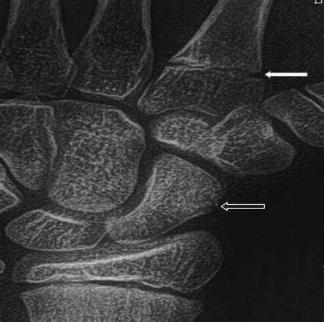 A Rare Complete Metacarpal Pseudoepiphysis In A Teenager Wit