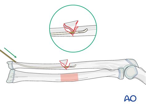 Ulna Complete Fracture Esin Retrograde