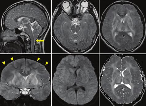 Preoperative Cervical Spine Sagittal Image Of T2wi Mri A Showed