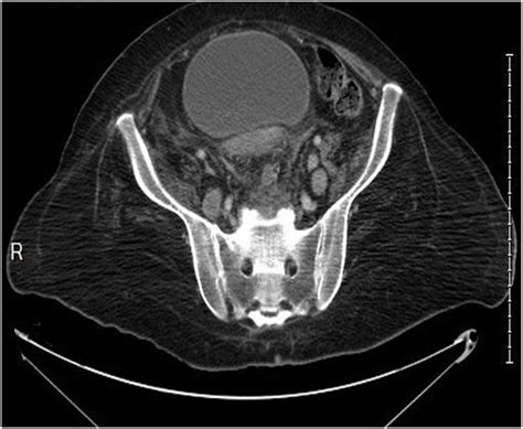 Pelvic Ct Scan