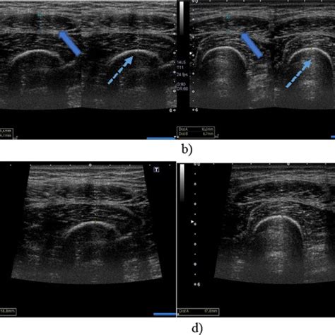 A 29 Year Old Male Patient Candidate For Left Aclr Surgery A