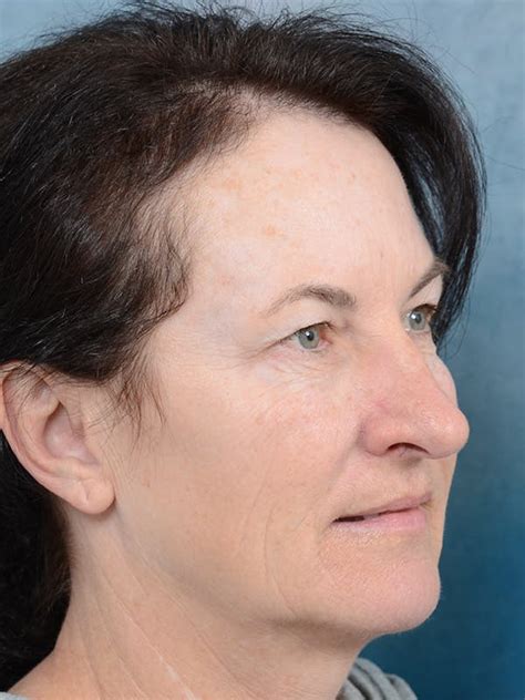 Patient 141068018 Brow Lift Before And After Photos Starkman Facial