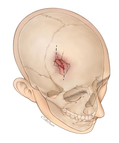 Linear Skull Fracture